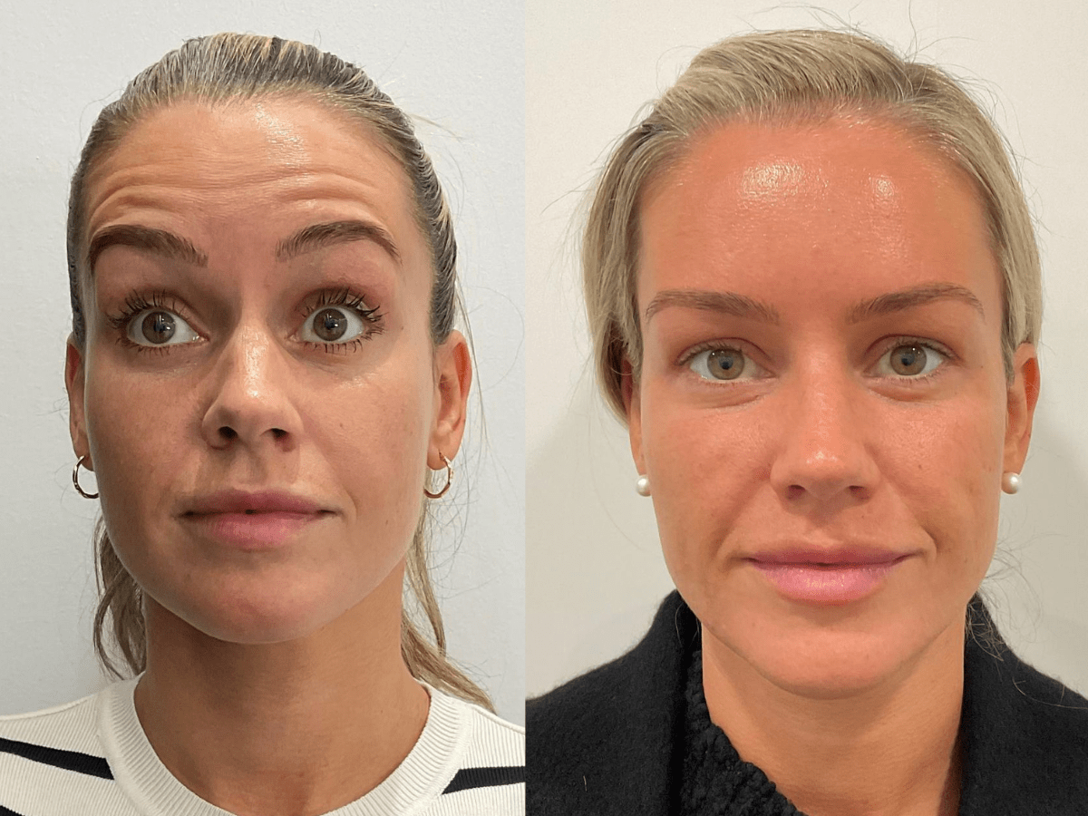 Book a Free Botox Treatment Consultation with Dr. Lauren